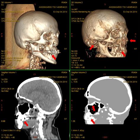 Clinical Evaluation Of Zero Echo Time Mr Imaging For The Segmentation Of The Skull Journal Of