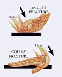 Smith And Colles Fracture Google Search Menschlicher K Rper Anatomie Handtherapie Anatomie