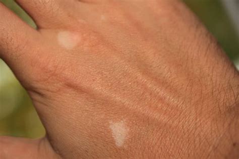 尋常性白斑が少しだけ治りかけてる Geekなぺーじ