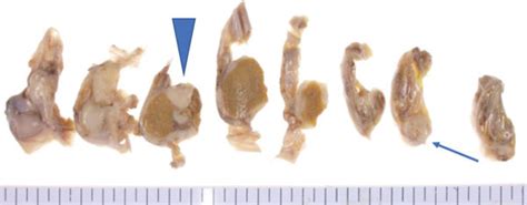 Macroscopic Views Of The Resected Specimen Showing Ill Defined White