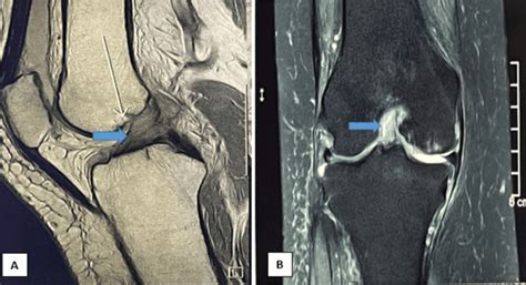 Mucoid Degeneration Of The Anterior Cruciate Ligament A Case Report Pmc