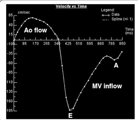 Flow Time Curve Generated By Cmr Phase Contrast Velocity Mapping Across