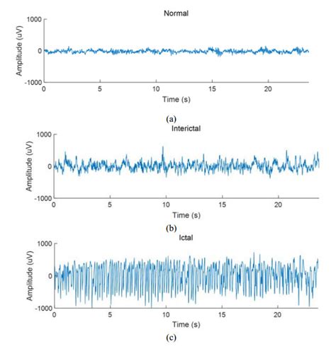 Multiscale Distribution Entropy Analysis Of Short Epileptic Eeg Signals