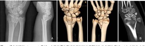 Die Punch Fracture Distal Radius Fractures Knowledge Amboss