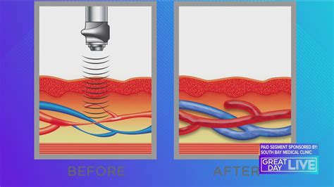 Treat ED Without Daily Medication Wtsp Com