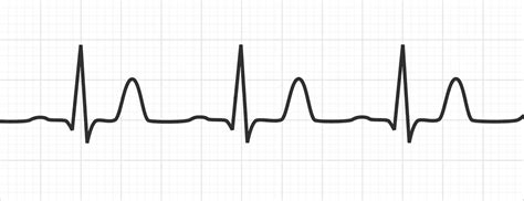 Severe Hyperkalemia Ecg