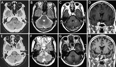 Right Intracavernous Hpc Preoperative Axial Ct Showed A Slightly Download Scientific Diagram
