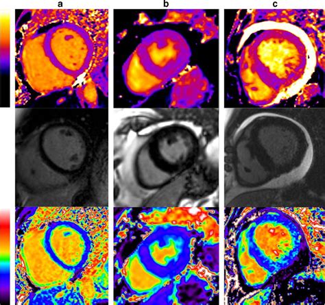 Native T1 And Ecv Mapping In Patients With Severe Aortic Stenosis And A
