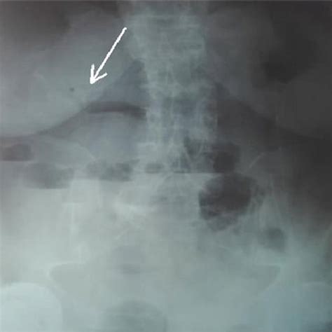 Chest Radiogram The Arrow Shows The Dilated Intrathoracic Stomach Download Scientific Diagram