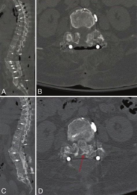 A Comparison Of CT Images Immediately After A And B And At 4 Months Download Scientific