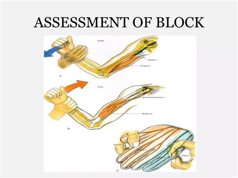 Brachial Plexus Blocks Pptx