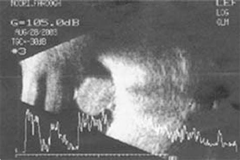 Figure 2 From Rubeosis Irides Complicating Acquired Astrocytoma Of