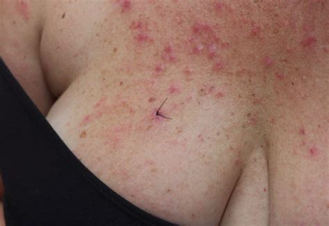 How To Avoid Vicryl Sutures Allergy？ Vicryl Suture Factory