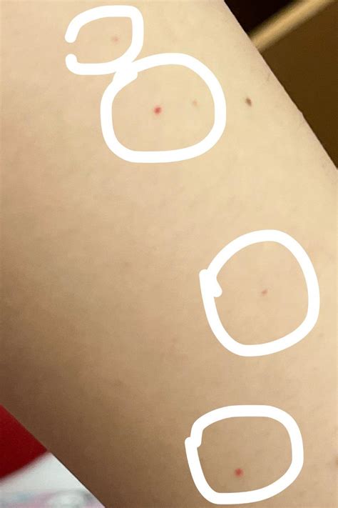 Have These Small Red Dotsmoles All Over My Arms Some On Legs And 2 3