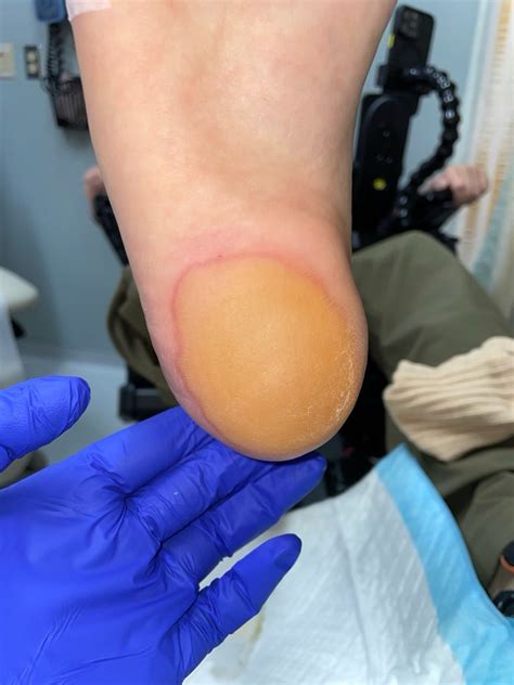 How To Care For Calluses Without Cutting Them Out Howard Falkinburg