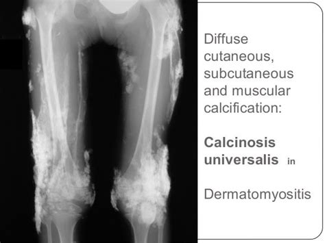 Myositis Ossificans