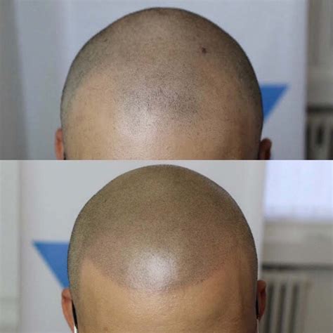Scalp Micropigmentation Before And After Gallery Best Smp Examples Scalp Micropigmentation Before And After Gallery Best Smp Examples