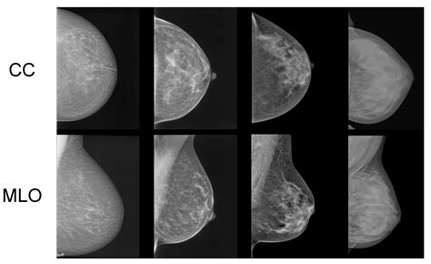 Machine Learning Based Approaches For Breast Density Estimation From Mammograms A Comprehensive