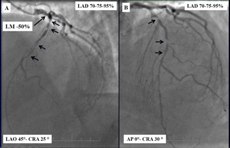 A 50 Stenosis Of The Distal Segment Of The Lmca B 70 75 95 Download Scientific Diagram