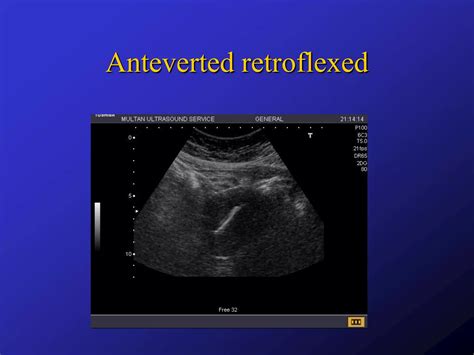 Ultrasound Of Uterus Part 1 Pptx