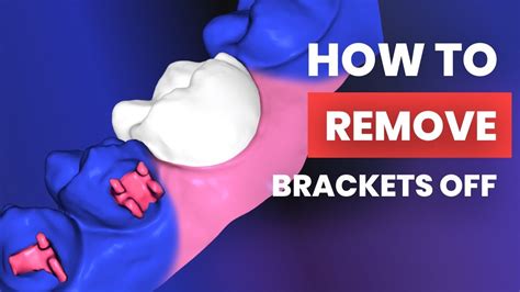 How To Remove Brackets Off 3d Orthodontic Model Youtube