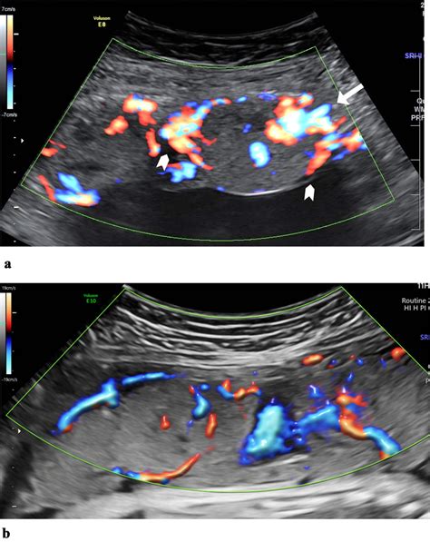 Blood Flow Pattern In The Placentone A In This Placenta Figo Grade 3