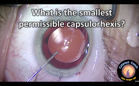 Smallest Rhexis 538 Title Cataract Coach™