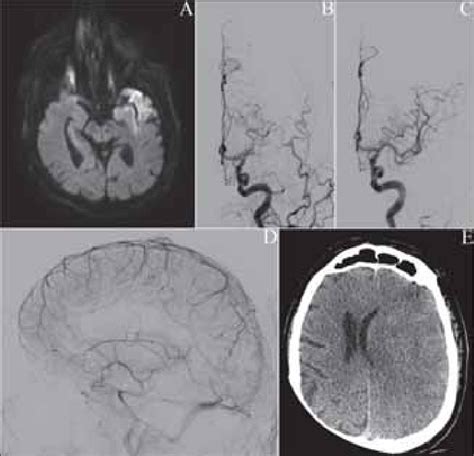 Illustrative Case 2 Patient In His Late 70s Nihss 25 Left M1 Segment Download Scientific