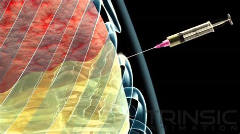 Thoracentesis Needle
