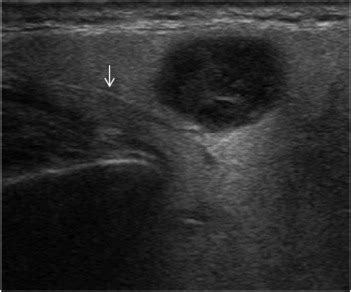 Ultrasonographic Localization Of Parotid Gland Tumor Relative To The
