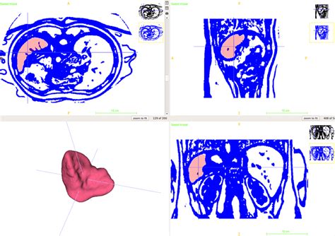 Results Of Spleen Segmentation α 02 β 095 Download