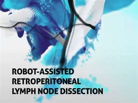 Robot Assisted Retroperitoneal Lymph Node Dissection Youtube