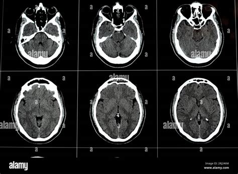 Brain Ct Scan Showing Brainstem Cavernoma Right Centrum Semiovale Developmental Venous Anomaly