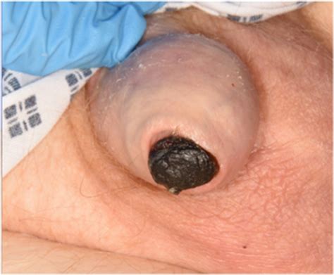 Management Of Chronic Urinary Retention In Glanular Penile Calciphylaxis Pmc