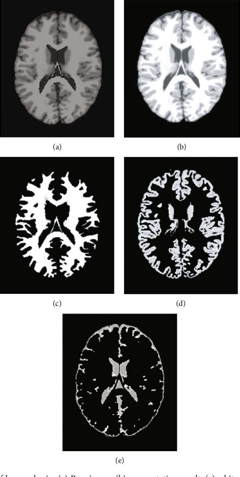 figure 1 from application of clustering based analysis in mri brain