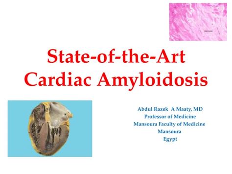 Cardiac Amyloid Heart Disease State Of The Art Power Point Lecture