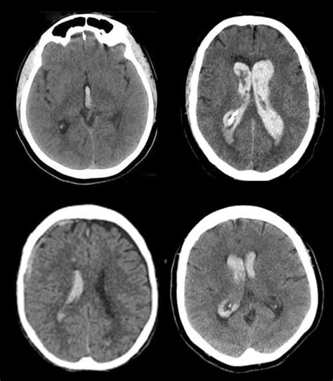 Intraventricular Hemorrhage Grades