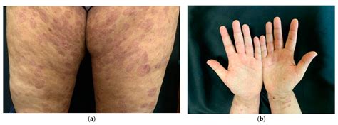 Gestational Pemphigoid