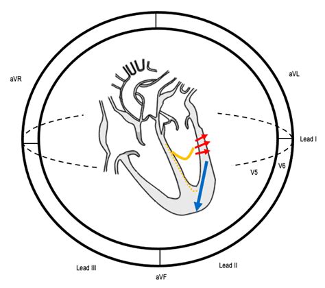 심전도 공부 Left Posterior Fascicular Block Lpfb 네이버 블로그