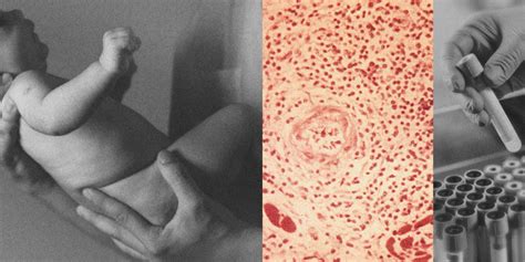 Mississippi Hit By 900 Spike In Babies Treated For Congenital Syphilis