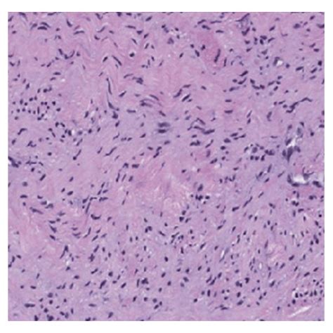 Histologically Diffuse Type Neurofibroma Arising In The Parotid Region