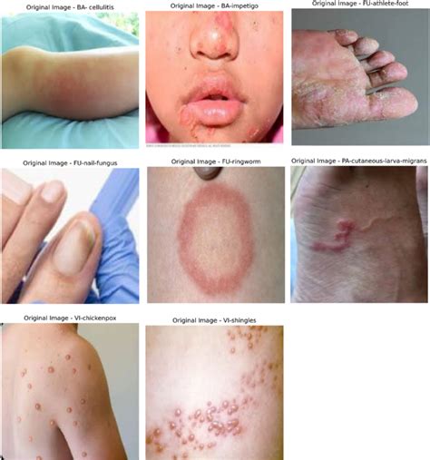 Automated Detection And Diagnosis Of Bacterial Skin Infections Using