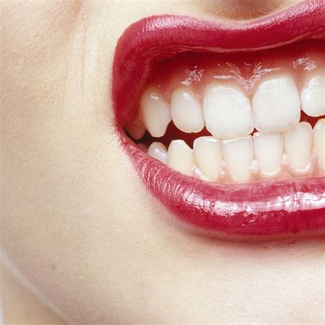 Dentists Report A Rise In Stress Induced Tooth Fractures