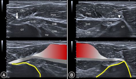 A Ultrasound Imaging Of The Right Proximal Region Shows Loss Of Download Scientific Diagram