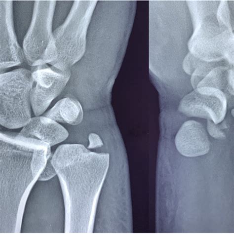 PDF Proximal Row Carpectomy For Complex Perilunate Fracture Dislocations With Migration Of
