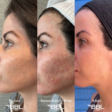 What Can You Not Do After Bbl Laser At Jackson Ribush Blog
