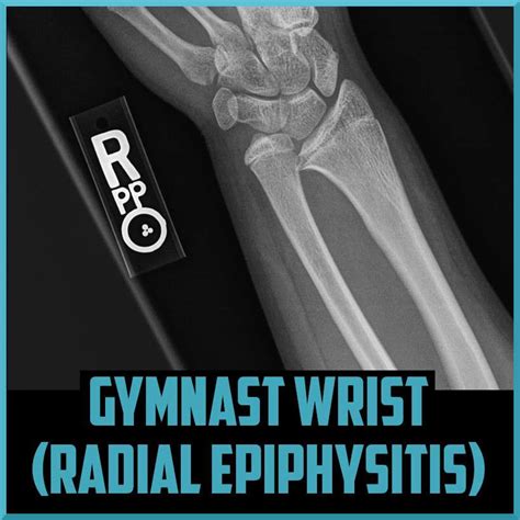 Gymnasts Wrist Radial Epiphysitis Sports Medicine Review