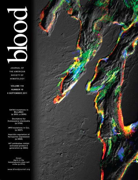 Irf4 Mutations In Chronic Lymphocytic Leukemia Blood American