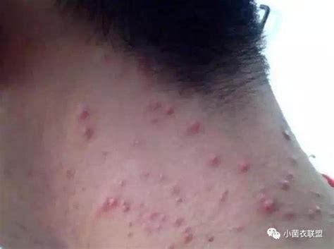 脖子上的小肉丁？你可别掉以轻心！ 微医（挂号网）