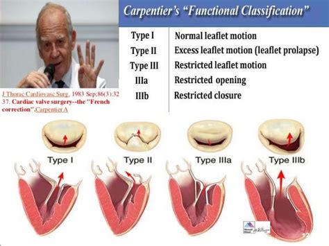 Percutaneous Treatment Strategies Of Valvular Heart Disease